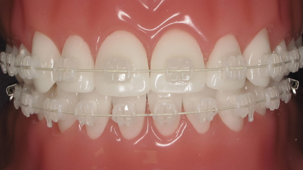 Ceramic Braces The Dental Arcade Blog Ceramic Braces The Dental Arcade Blog