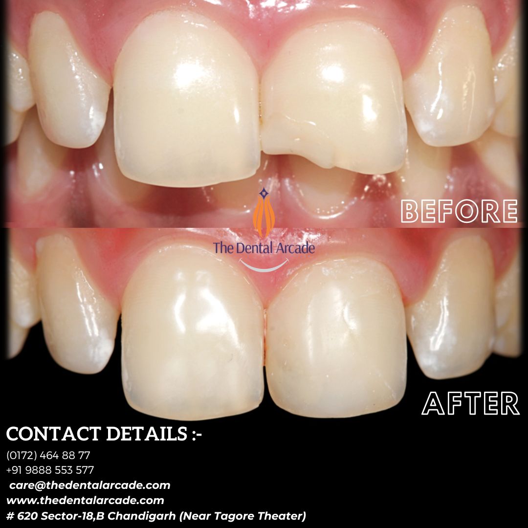 Composite Restoration The Dental Arcade Blog